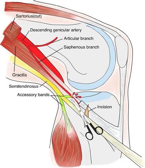 Acl Reconstruction With Hamstring Graft Clinicspots