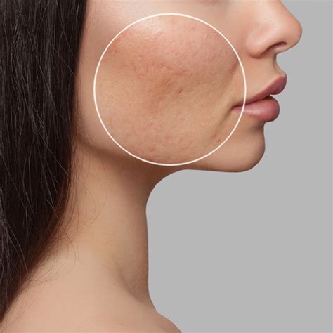 Acne Scars Types Of Acne Scars And Acne Scars Treatment Ecosh