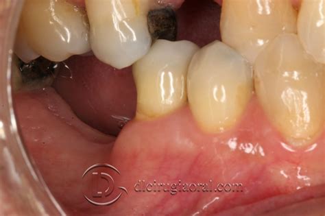 Reconstruction Of Vertical Bone Defect In The Mandible Case