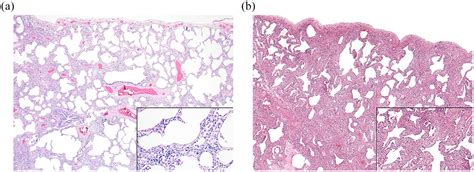 Pulmonary Fibrosis Histology
