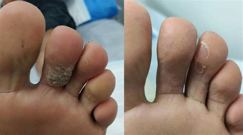 1 1plantar Wart Foot And Podiatry Surgery