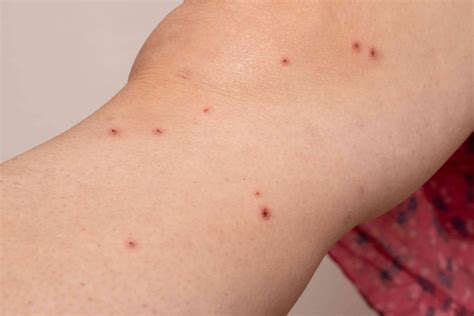 Chickenpox Rash When Is Chickenpox Contagious Key Signs Youre Still