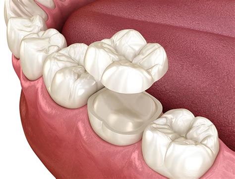 Inlay Onlay Dr Joseph Spina Dmd Ficoi Dentist Wayne Pa