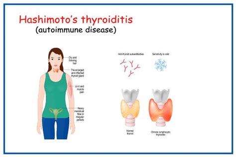 Hashimoto Thyroiditis Faqs