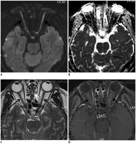 Fiftyseven Year Old Woman With Postoperative Bilateral Acute Ischemic