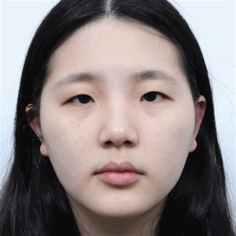 The Truth About Ptosis Correction In Korea Surgical Challenges With Real Cases Noonopi