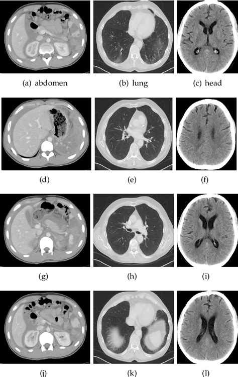 Figure 4 From Low Dose Ct Image Denoising Using Image Decomposition And Sparse Representation
