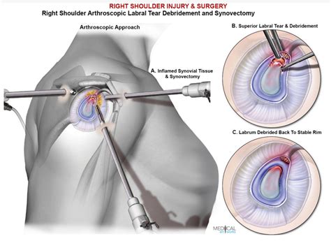 Torn Labrum From A Car Accident Find Out What It S Worth In Nyc