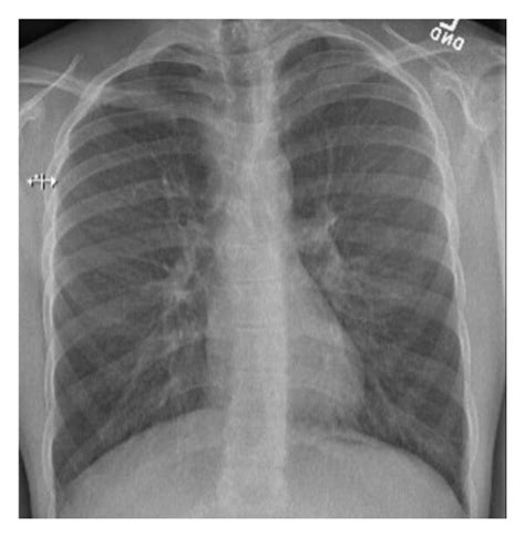 A Posterior Anterior Chest X Ray Reveling Diffuse Fine Download Scientific Diagram
