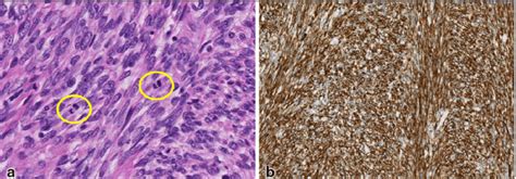 Histological Findings The Tumor Is Composed Of Spindle Shaped Cells