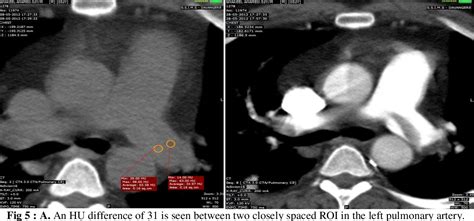 Figure 5 From Hounsfield S Unit Hu Value Inthe Detection Of Thrombus Involving Pulmonary