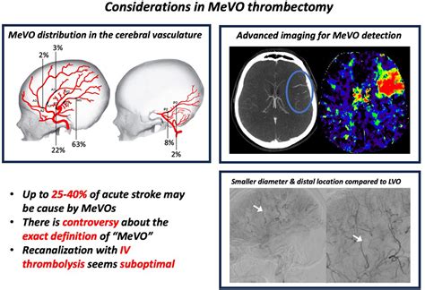 Endovascular Treatment Of Medium Vessel Occlusion Stroke Stroke