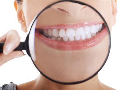 Dental Enamel Defects White Spots On The Teeth Sanident