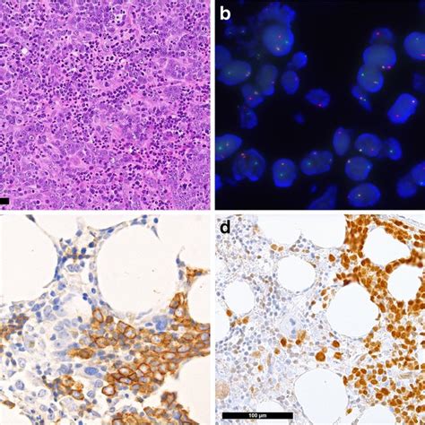 How To Differentiate Myeloid Lymphoid Neoplasm With Eosinophilia And