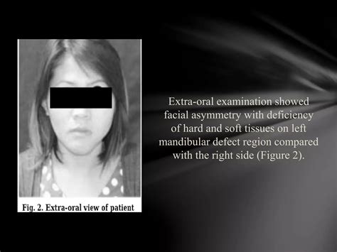 Mandibular Defects Maxillofacial Prosthesis Ppt
