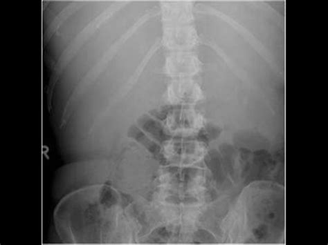 Abdomen And Retroperitoneum 11 Liver Case 114 Liver Cysts
