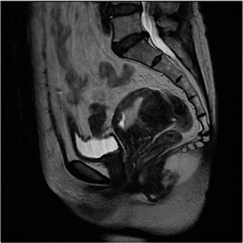 Preoperative T2 Weighted Magnetic Resonance Imaging Scan Sagittal