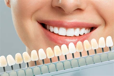 웃는 젊은 여자 치과 진료소에서 미용 치아 미백 임플란트 치아의 음색 선택 30 34세에 대한 스톡 사진 및 기타 이미지