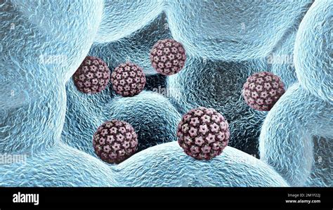 Human Papillomavirus Infection Virus Hpv Is The Most Common Sexually