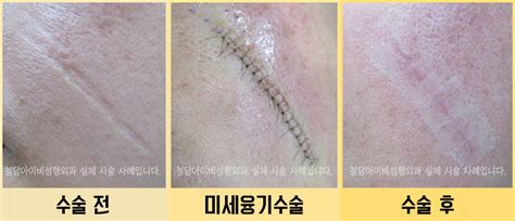 뺨 부위의 함몰 흉 제거 수술 9주 후 흉터치료 전후 청담아이비성형외과