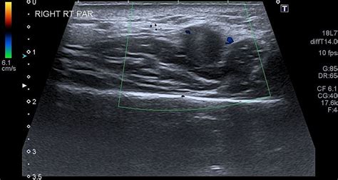 Nodular Fasciitis Of The Masseter Bmj Case Reports