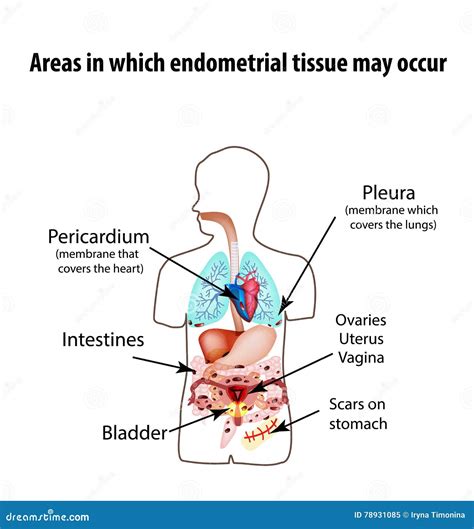 Endometriosis The Structure Of The Pelvic Organs Adenomyosis The Endometrium Vector