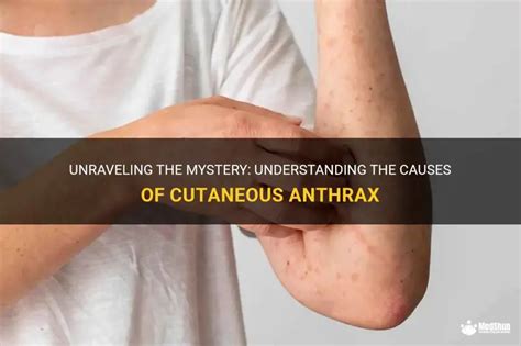 Unraveling The Mystery Understanding The Causes Of Cutaneous Anthrax