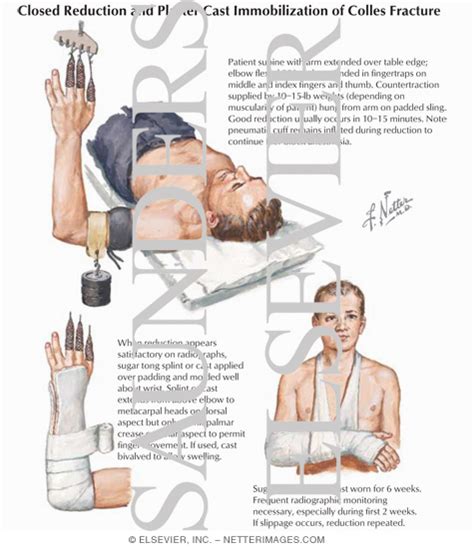 Closed Reduction And Plaster Cast Immobilization Of Colles Fracture