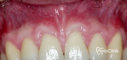 Periodontal Plastic Surgery In Gatineau PerioClinik