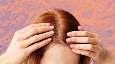 Que Faire Contre Le Psoriasis En Plaques Sur Votre Cuir Chevelu