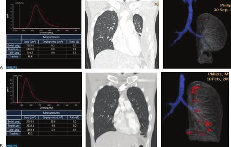 Lung Densitometry Using 3d Reconstruction Ct Preoperative A And