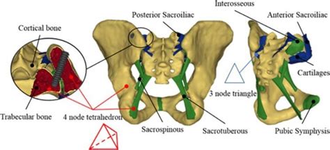Finite Element Model Of Pelvis Instrumented With Rialto Implant 50