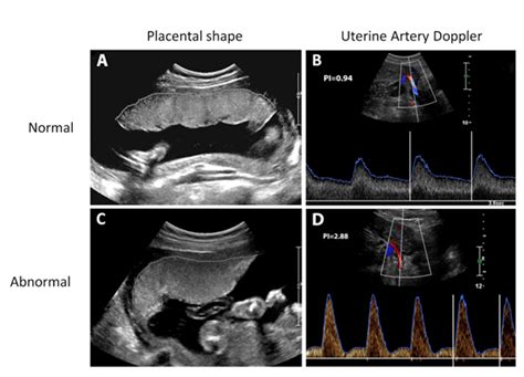 Abnormal Placenta Ultrasound Images
