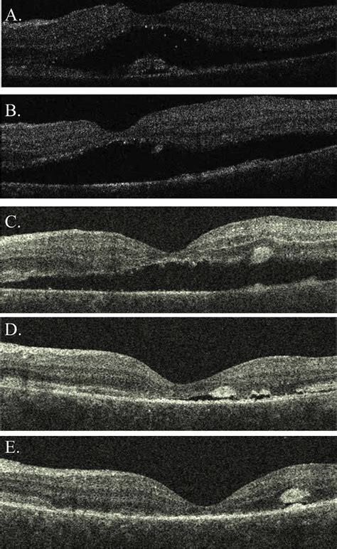 Macula Oct