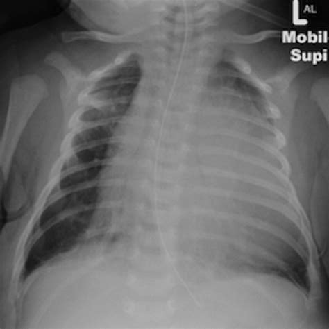 Chest X Ray Showing Cardiomegaly With Patchy Atelectasis And