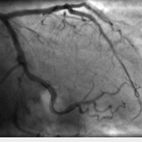 Post Pci Lm Stent Into Proximal Lad With Timi 3 Flow And Excellent Download Scientific Diagram