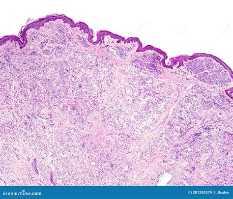 Human Skin Nevus Stock Image Image Of Micrograph Dermatopathology
