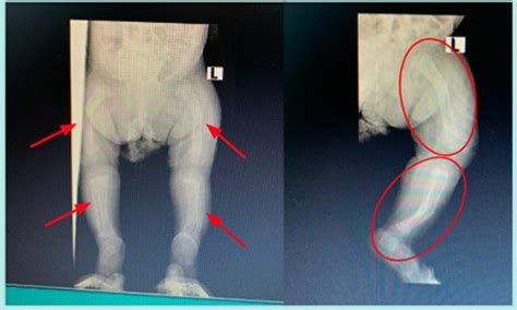X Ray Lower Extremity Bilateral Ap Lateral View Findings Bowing Os Download Scientific