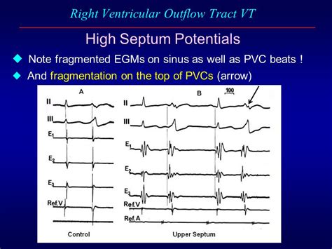 Arvcsgf Rvot Vt Extensive Discussion On The Risk Of Sudden Death About