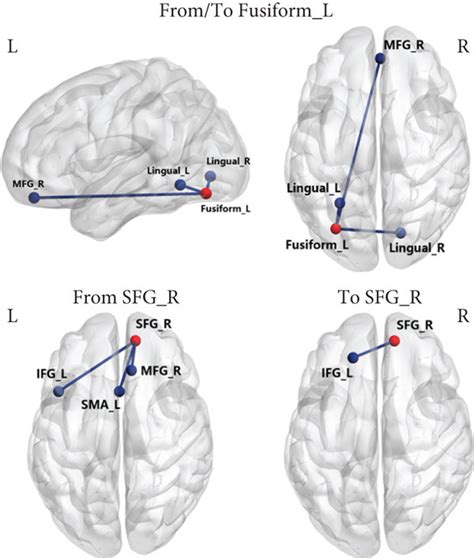 Altered Effective Connectivity Of Left Fusiform And Right Superior Download Scientific Diagram