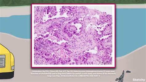 Biliary Cysts And Cholangiocarcinoma Free Sketchy Medical Lesson