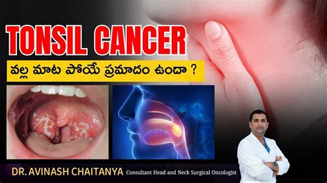 Tonsil Cancer Treatment Management Of Tonsillar Carcinoma With