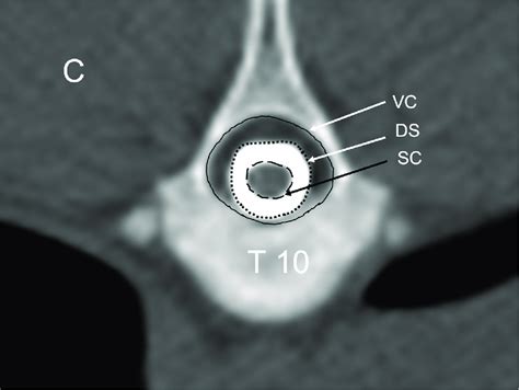 Transverse Ct Myelogram Image Showing Manual Delineation For Area
