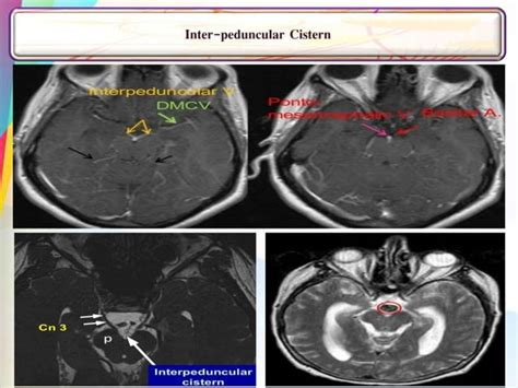 Csf Cisterns Ppt