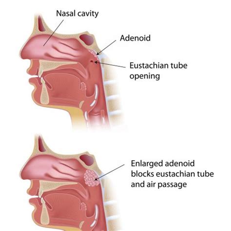 Adenoidectomy Before And After