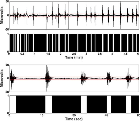 A 5 Min Of Burst Suppression Recorded From A Patient Following A