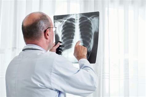 Lung Cancer Chest X Ray