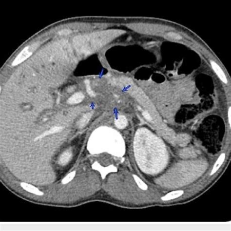 Ct Of The Abdomen Ct Of The Abdomen Showing An Infiltrative Process In Download Scientific