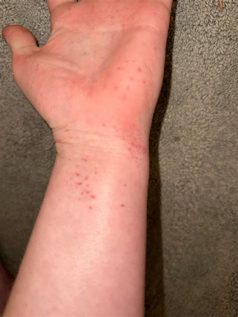 Red Dots Appearing All Over Body Rdermatologyquestions