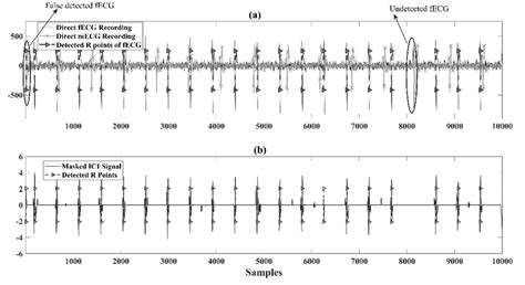A Direct Fecg Recording Direct Mecg Recording And Detected R Points